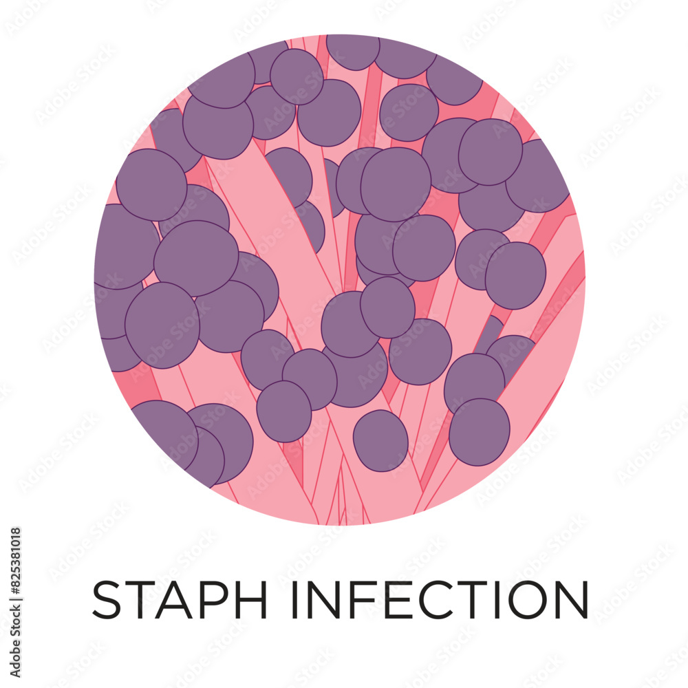 Staph infection flat style vector illustration in circle layout with ...