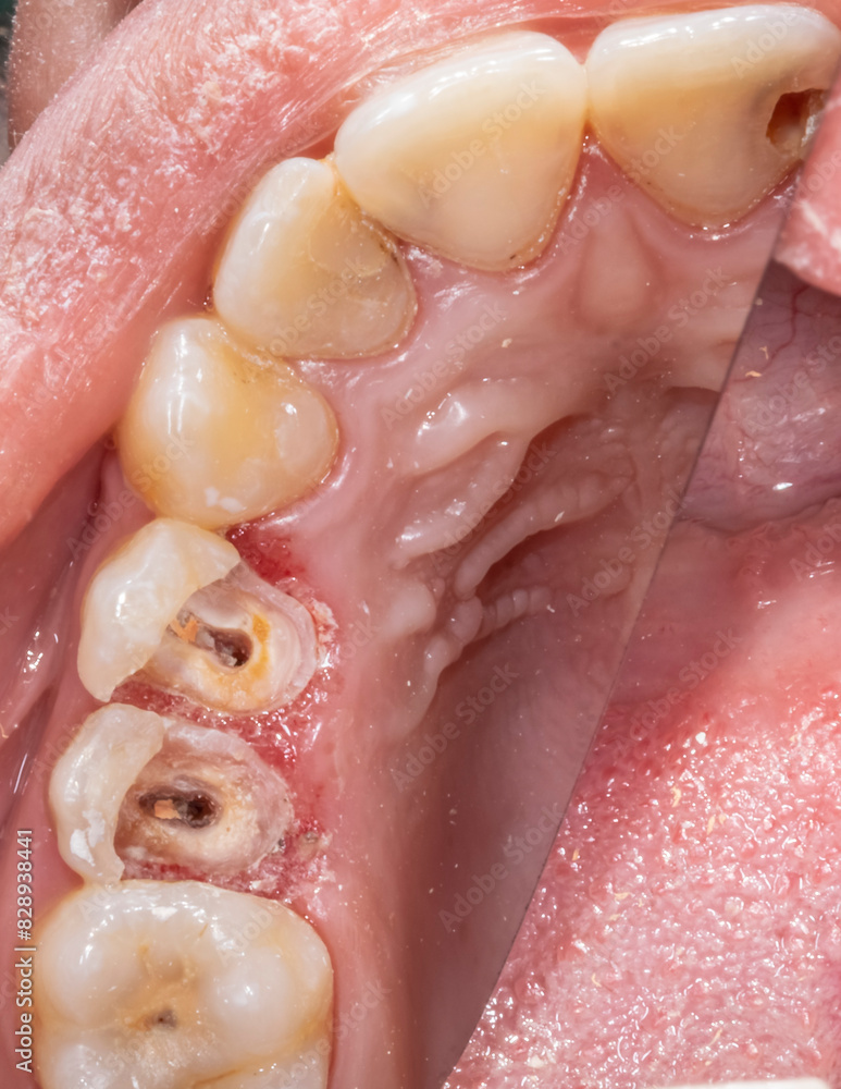 Upper maxillary arch closeup view with decayed teeth, premolars crowns ...