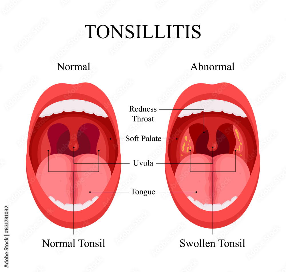 Diagram of Tonsillitis Causes, Normal Tonsils and Swollen Tonsils Stock ...