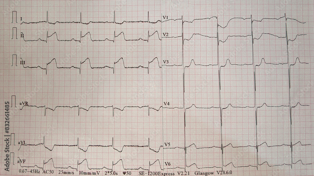12 Lead ECG showing ST segment elevation in lead II, III and aVF which ...