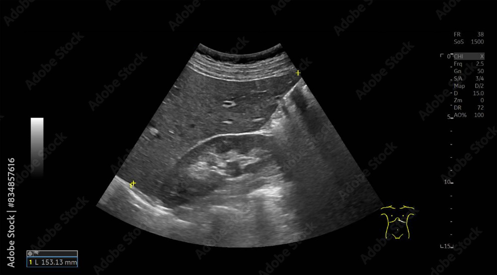 Kidney Ultrasound Images with Detailed Renal Structures, Perfect for ...