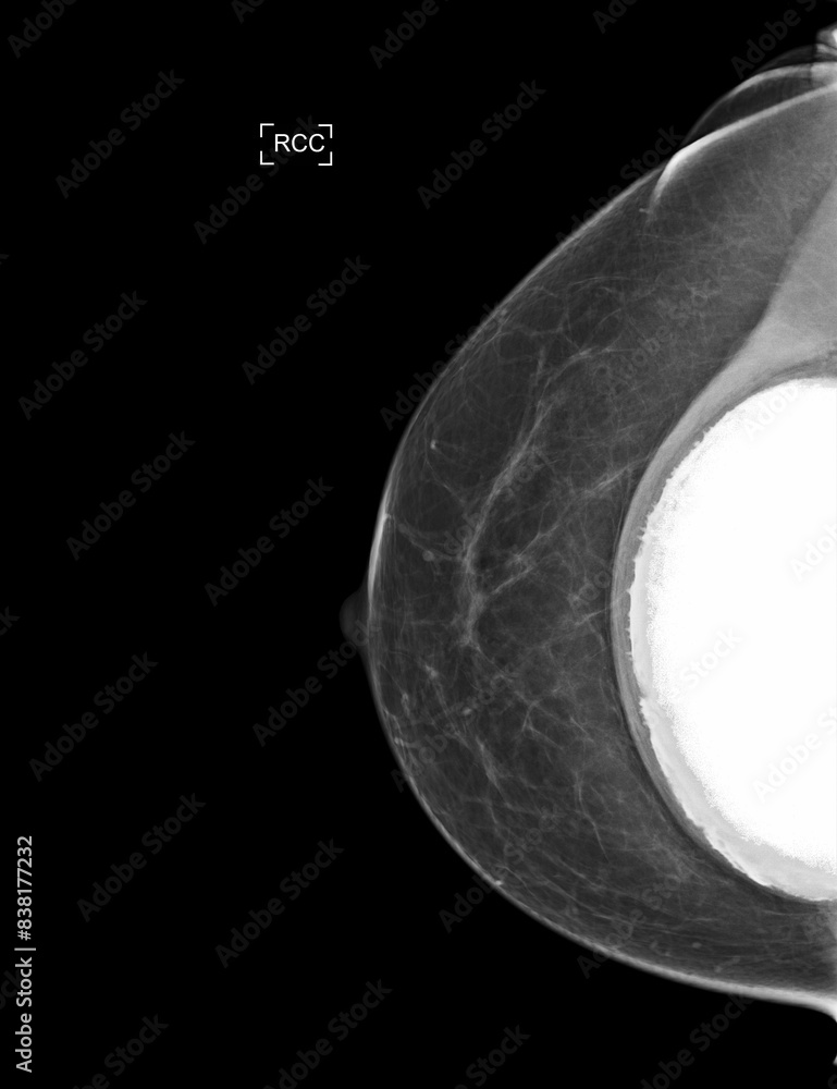 The mammogram BI-RADS 2-benign shows a breast implant augmentation with ...