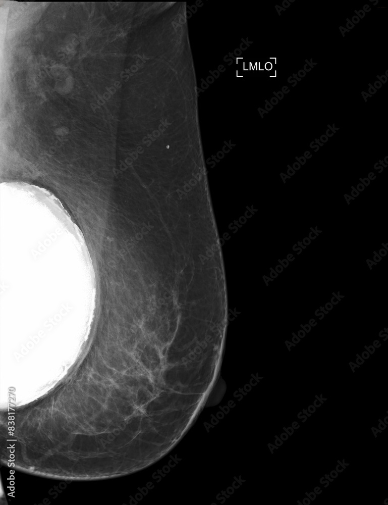The mammogram BI-RADS 2-benign shows a breast implant augmentation with ...