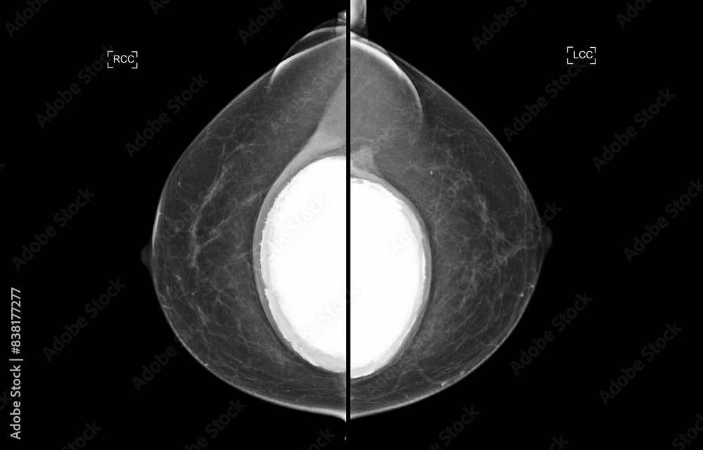 The mammogram BI-RADS 2-benign shows a breast implant augmentation with ...
