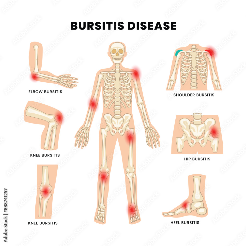 Different types of bursitis as medical body joints inflammation list ...