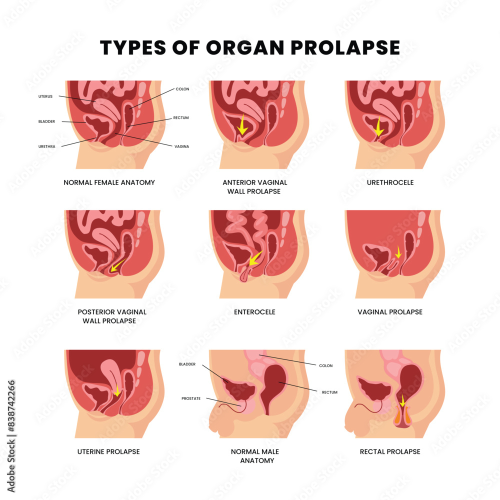 Set different types of organ prolapse diagram scheme infographic poster, uterus disorder Pelvic ...