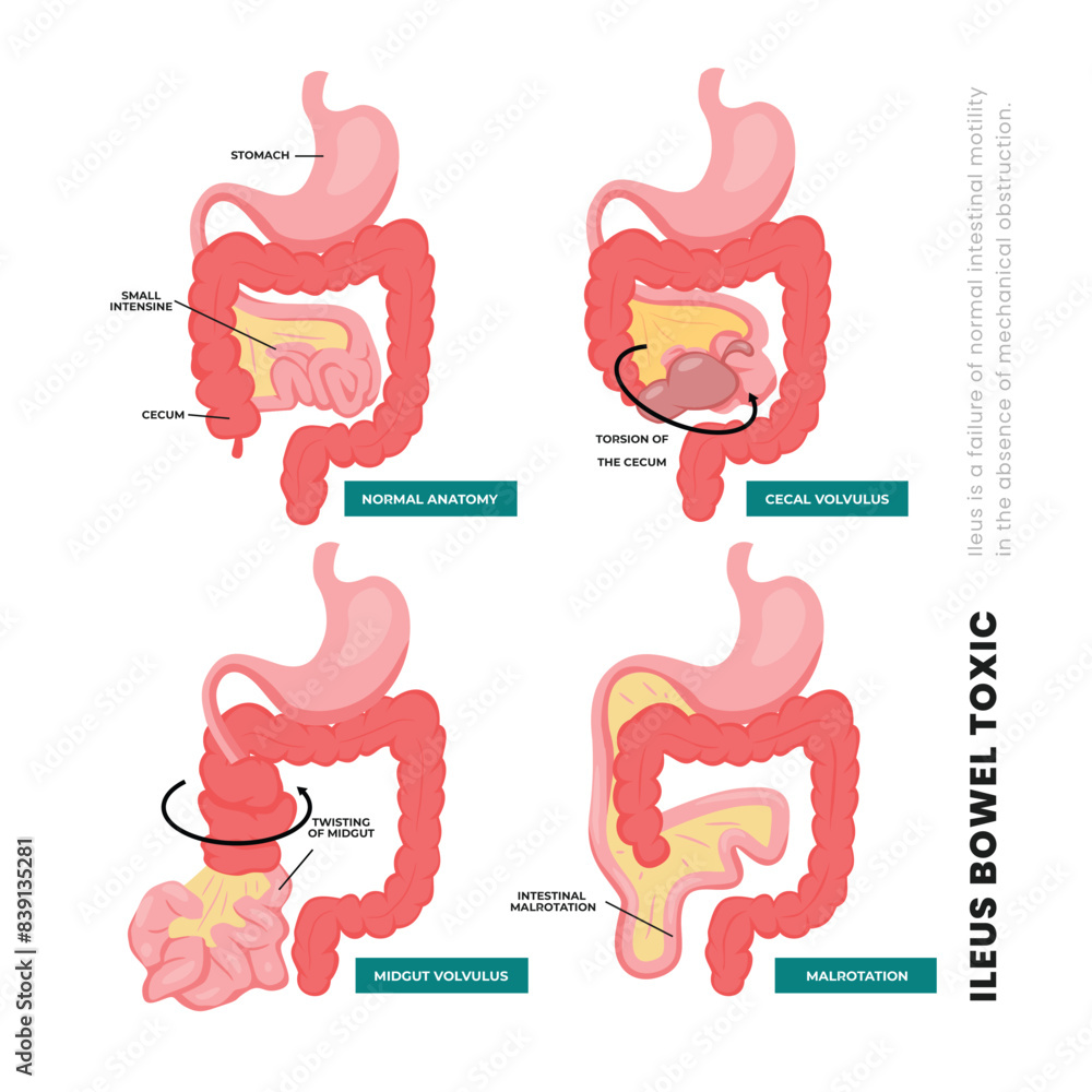 Set of different types of ileus bowel toxic poster scheme, with normal ...
