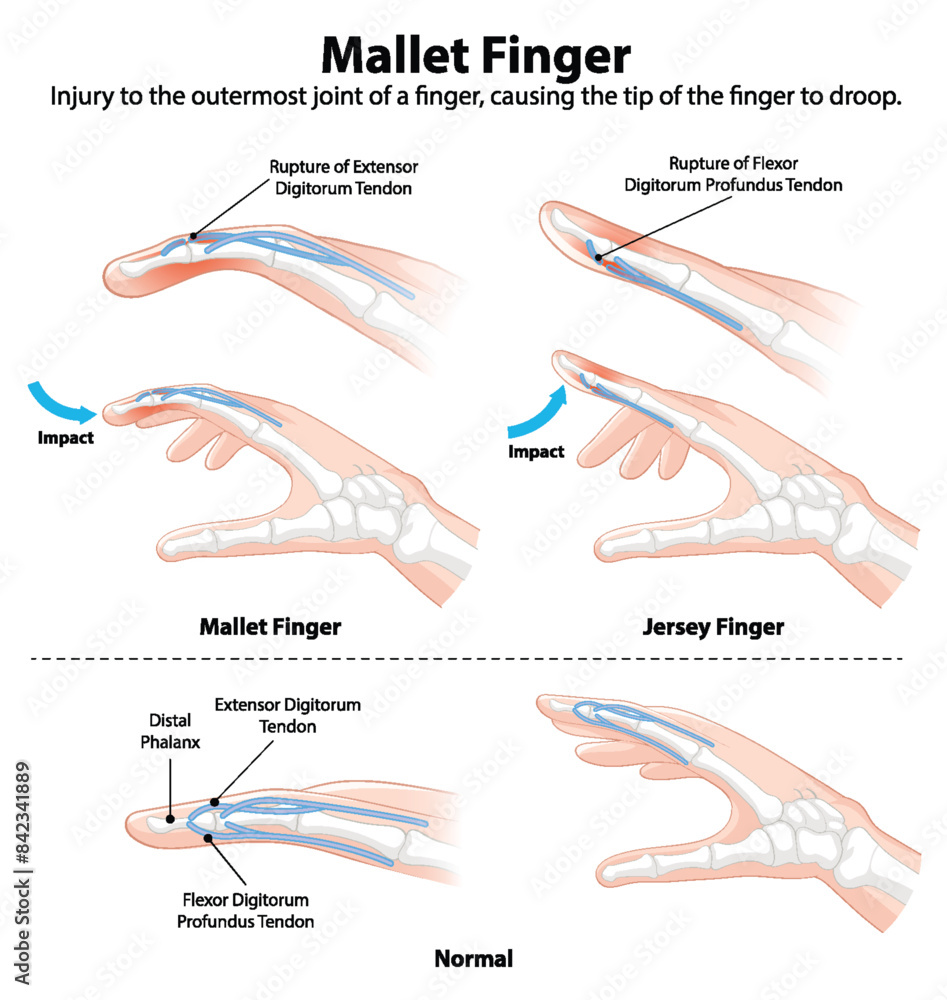 Illustration of finger tendon injuries and normal anatomy Stock Vector ...