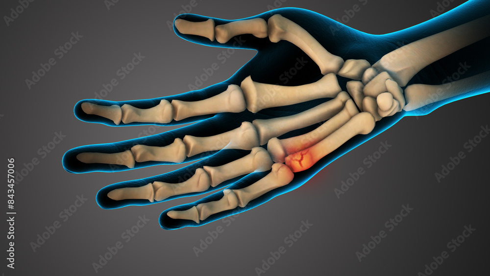 Hand metacarpal Cracked bone Anatomy Stock Illustration | Adobe Stock