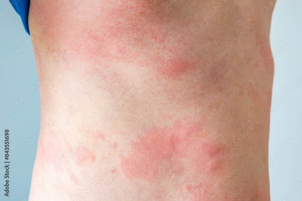 Young asian man itching and scratching on his back from allergic itchy ...