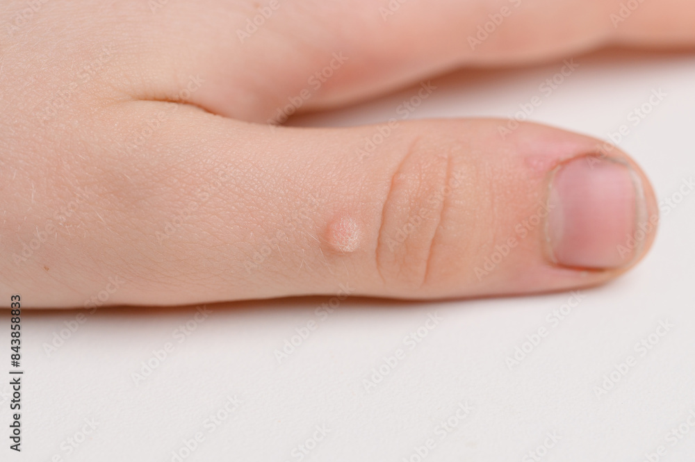 Wart on finger. Close-up of wart on child hand. Common wart Verruca vulgaris is caused by type ...