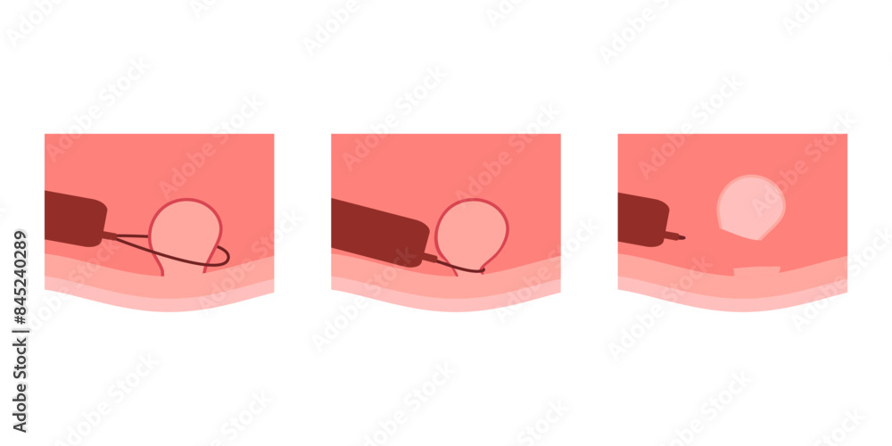 Stage removal polyp in colon, colonoscopy intestine, polypectomy ...