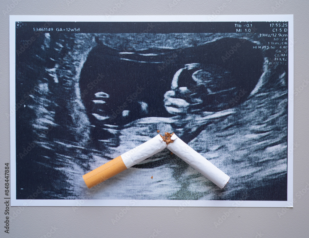 Baby ultrasound with smoking cigarette. Pregnant woman. Having a baby ...