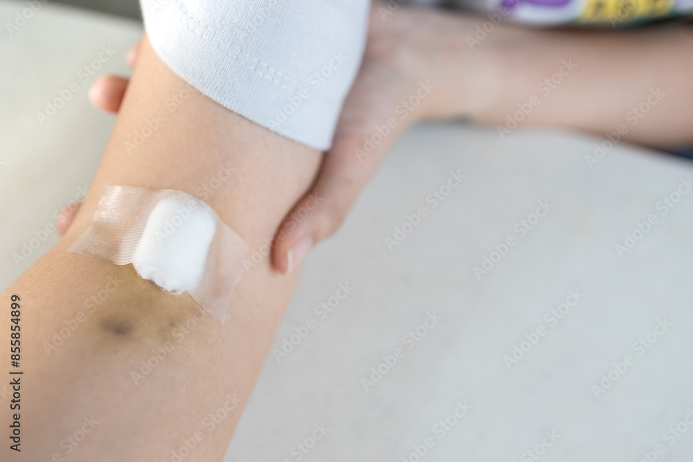 Arm of woman with bruise on foldable joint after taking blood sample ...