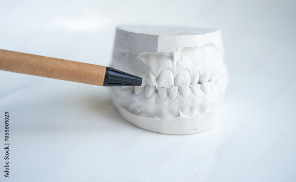 White plaster impression of the dental jaw of a patient with crooked ...