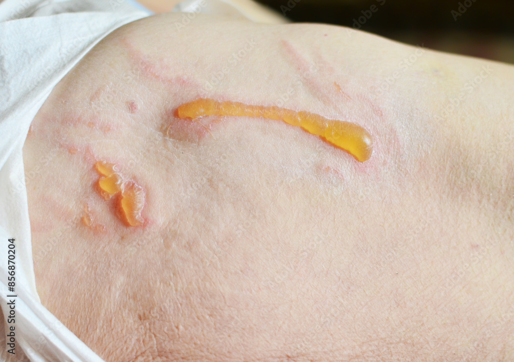 Decubitus ulcer. Pressure ulcers on skin tissue. The increased pressure ...