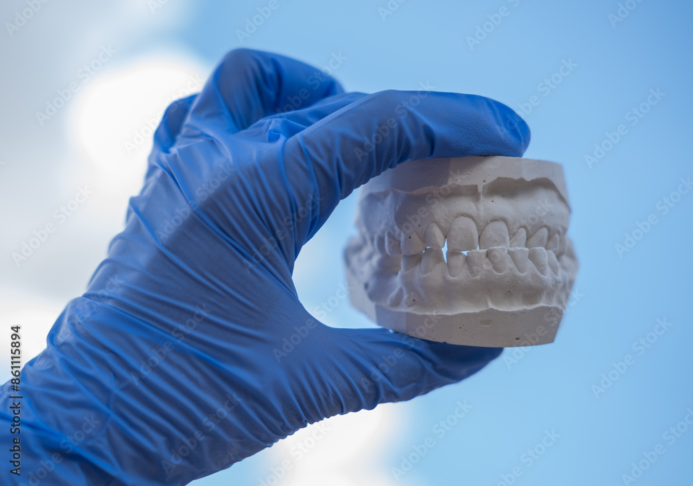 White plaster impression of the dental jaw of a patient with crooked ...