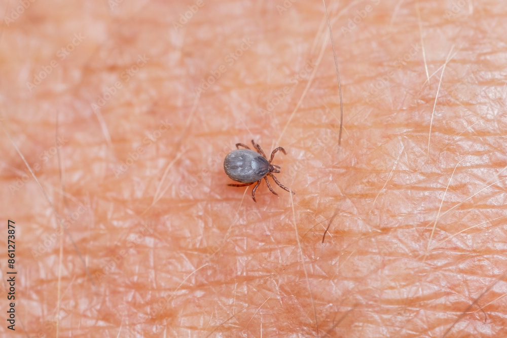 A tick on the skin that transmits dangerous diseases such as tick-borne ...