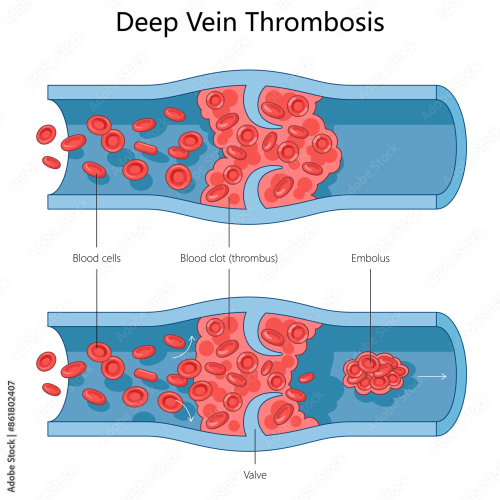 formation of a blood clot in a vein, representing Deep Vein Thrombosis DVT and its progression ...