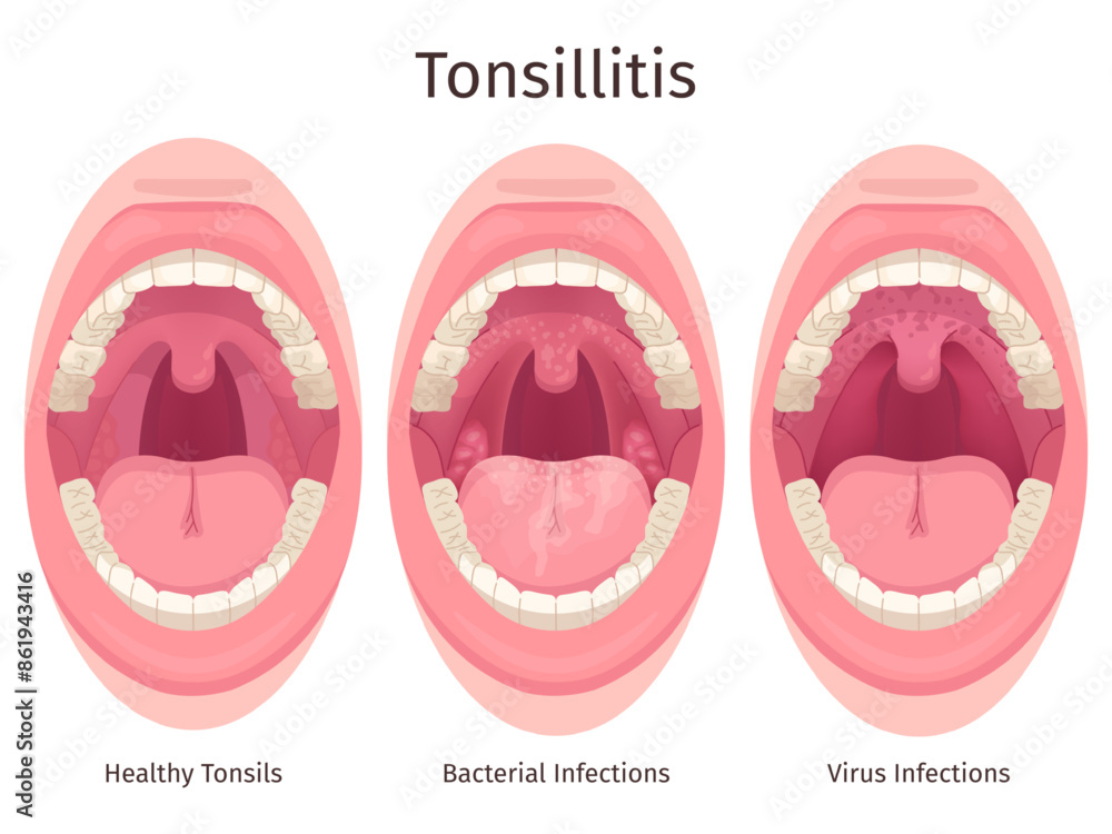Tonsils. Human sore throat airways inflammation tonsil lymph and tongue ...