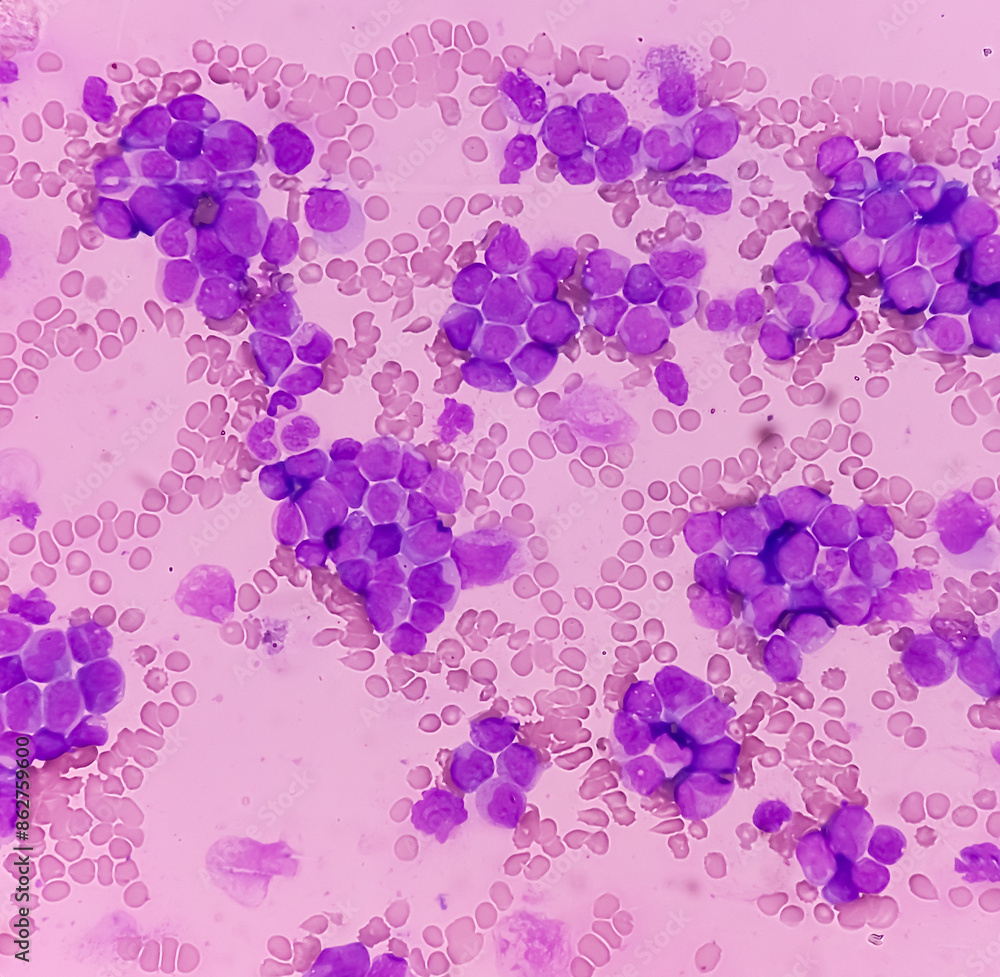 Acute myeloid leukemia (AML). Smear show monocytes and mostly blast ...