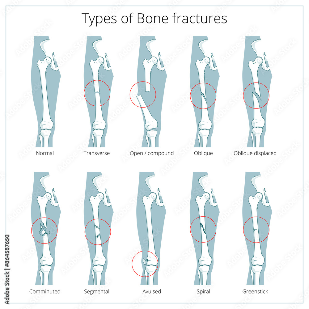 Types of bone fractures medical skeleton anatomy educational PNG ...