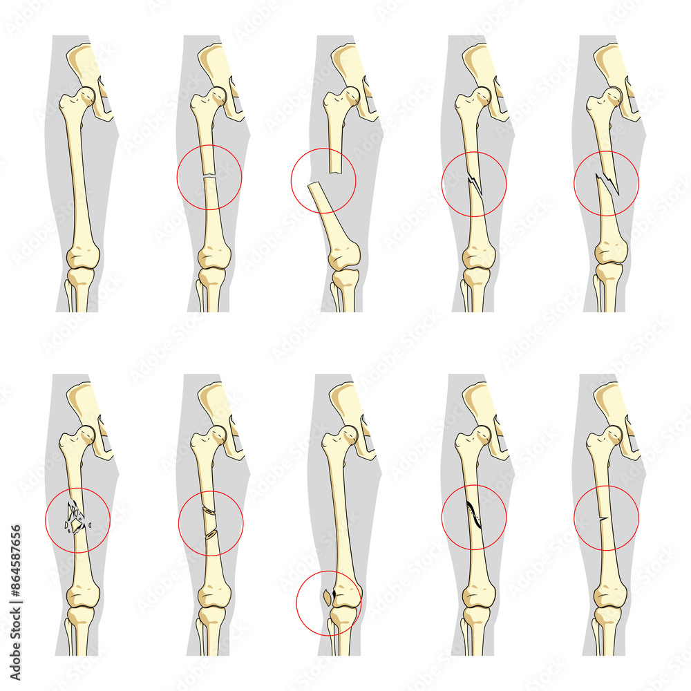 Types of bone fractures medical skeleton anatomy educational PNG ...
