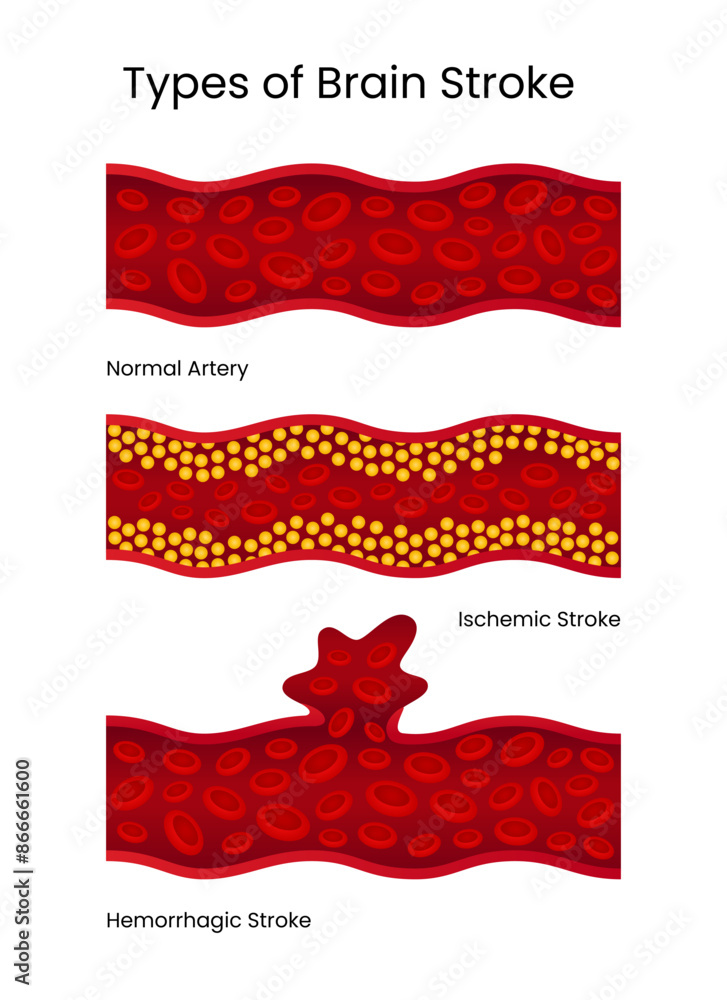 Types of brain stroke. Normal Artery. Ischemic Stroke. and Hemorrhagic ...