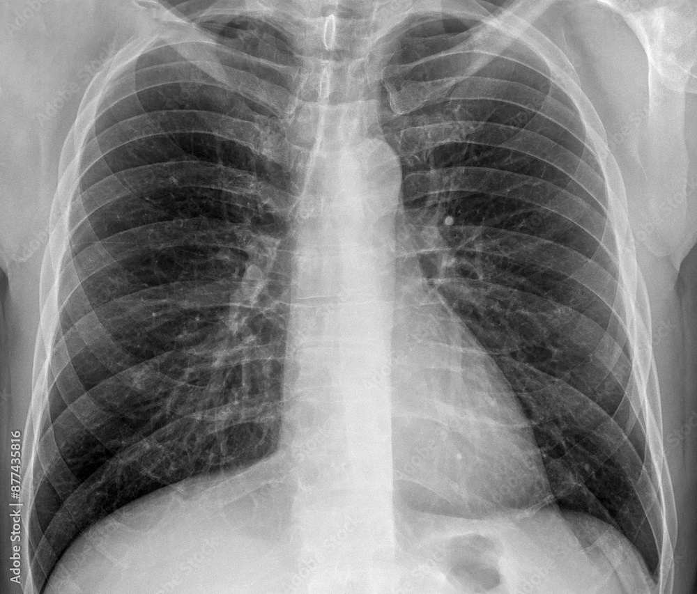 "Medical imagery, lung health, x-ray, radiology and anatomy, showcasing ...