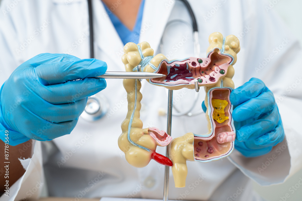 Ulcerative Colitis. Intestine, appendix and digestive system, doctor ...