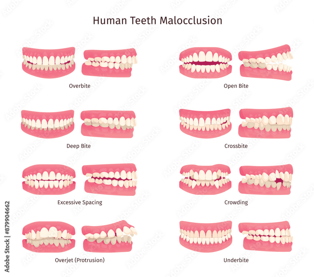Malocclusion. Tooth open bite protruding mouth jaw problem orthodontics ...