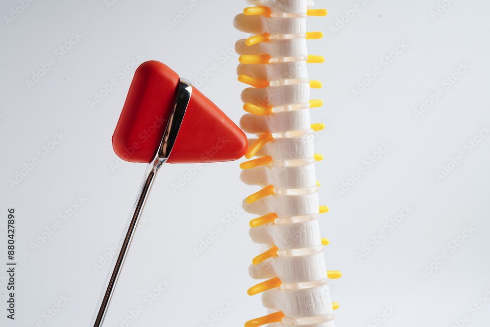 Spinal nerve and bone with knee reflex hammer, Lumbar spine displaced ...