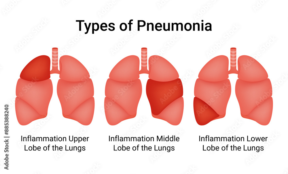 Types of Pneumonia. Inflammation of Upper, Middle, and Lower Lungs ...