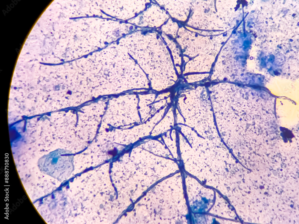 Microscopic fungi Malassezia furfur, showing yeast cells and hyphae ...