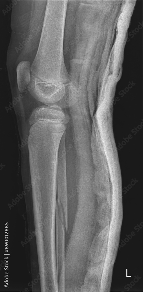 X-ray of Tibia and Fibula Fracture Stock Photo | Adobe Stock