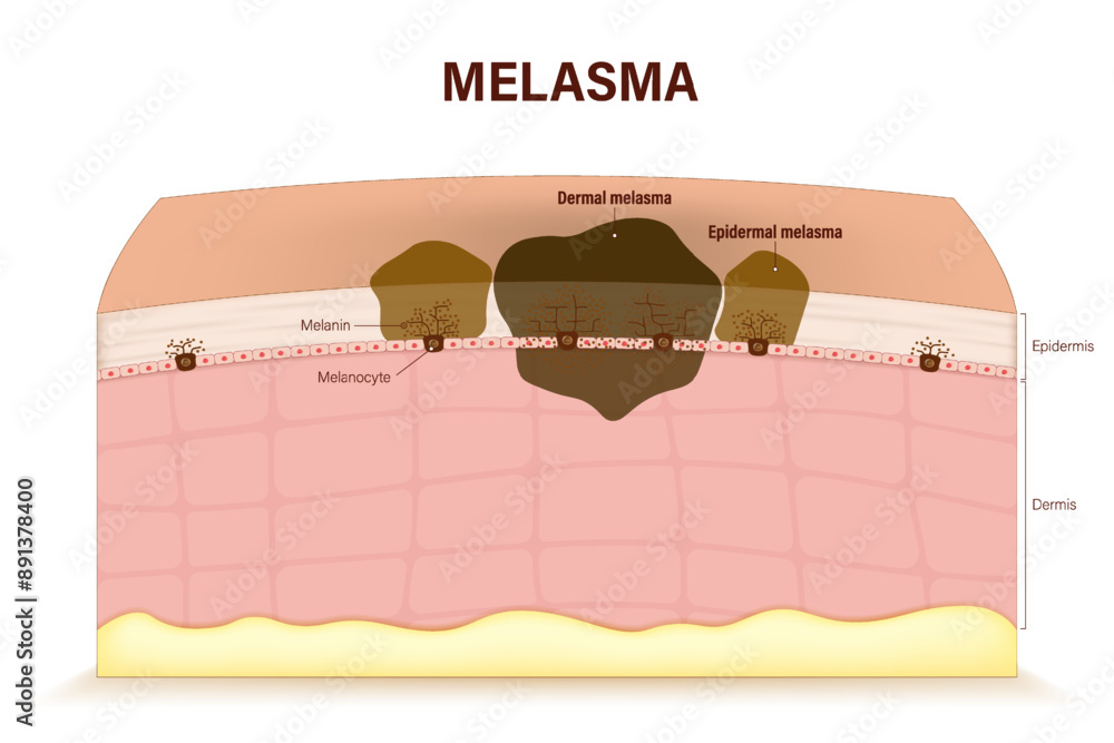 Melasma vector. Epidermal and dermal melasma. Facial skin problems ...