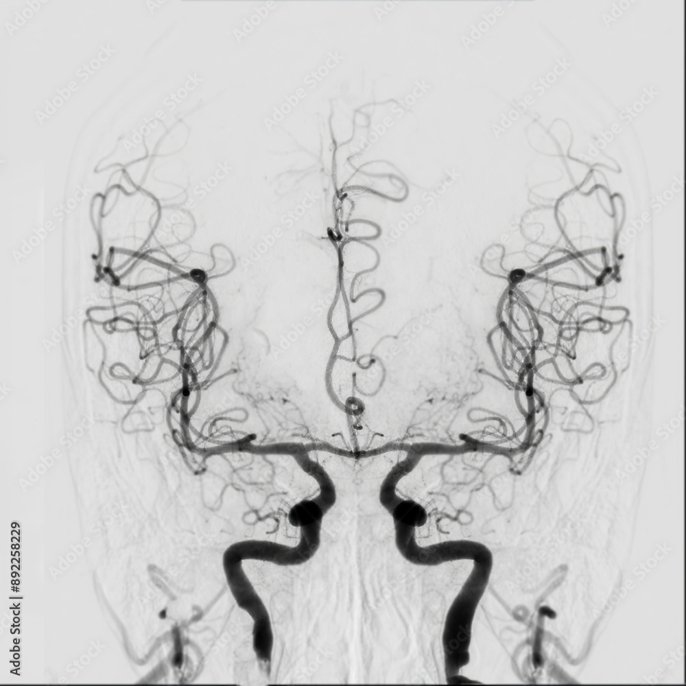 Cerebral angiography is a specialized procedure to visualize the ...