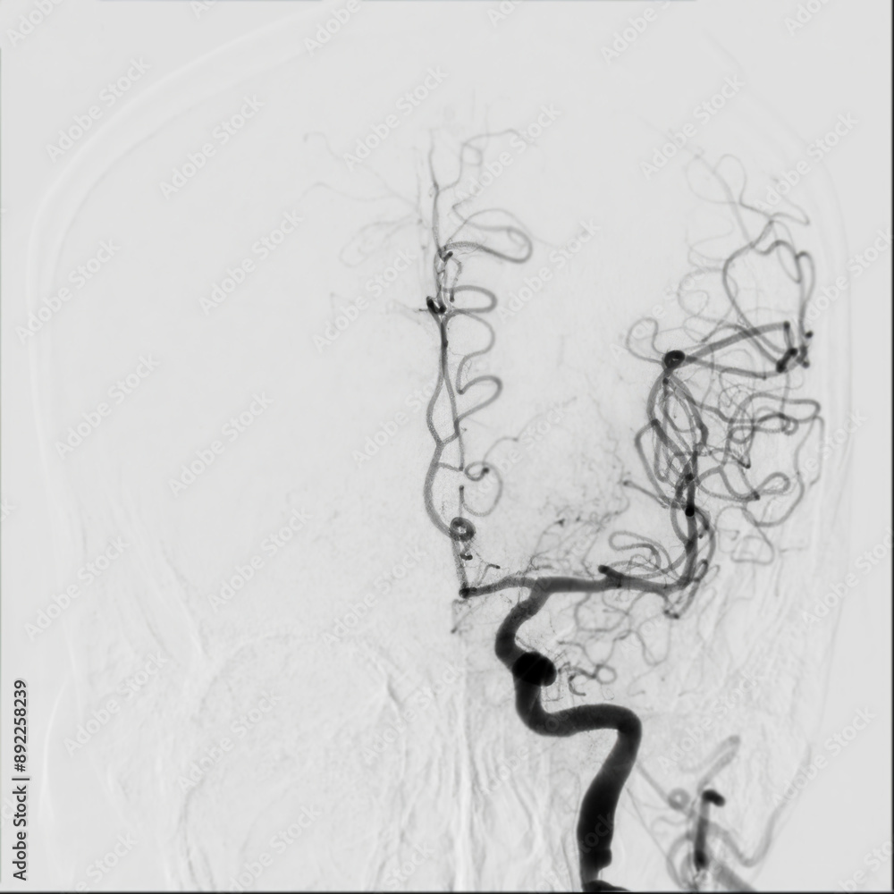 Cerebral angiography is a specialized procedure to visualize the ...