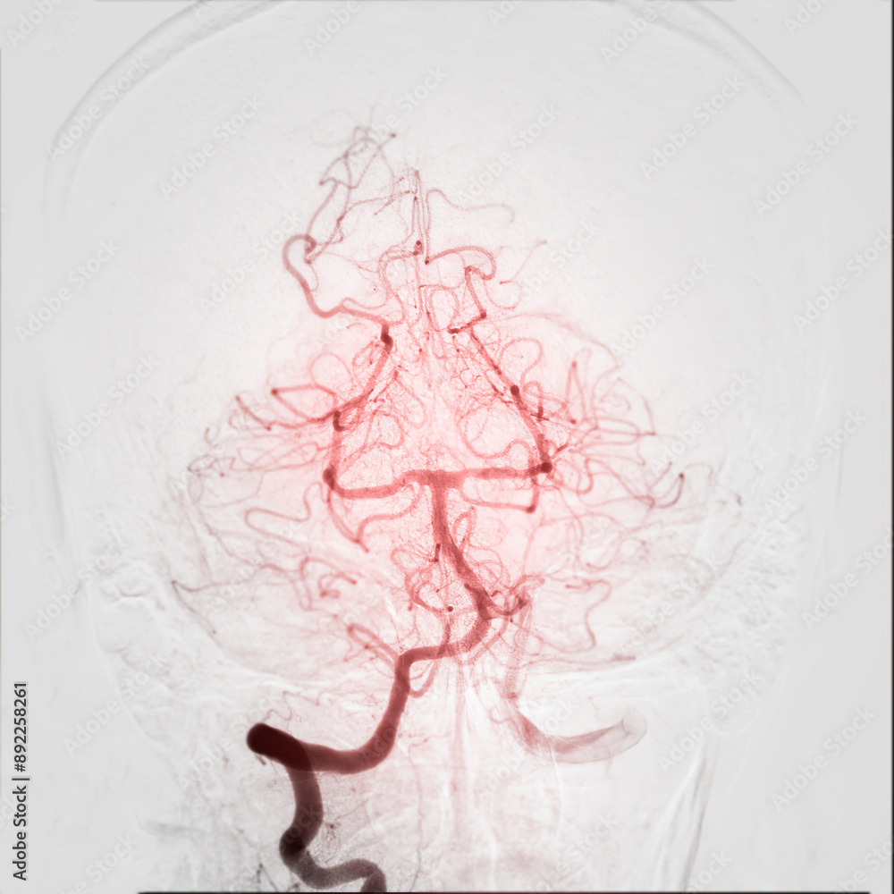 Cerebral angiography is a specialized procedure to visualize the ...