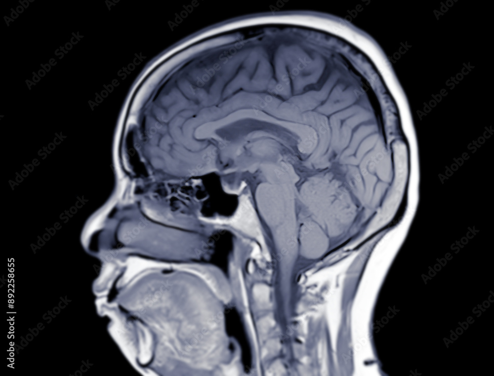 MRI brain scan sagittal T1W for detect Brain diseases sush as stroke ...