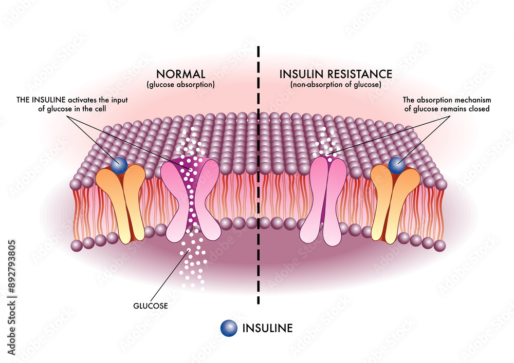 Medical illustration shows in a simple and schematic way the mechanism of insulin resistance ...