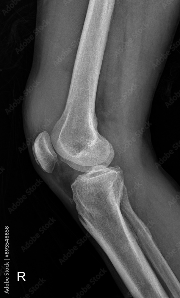 Radiographic Assessment of Tibial Fractures: Orthopedic X-ray ...