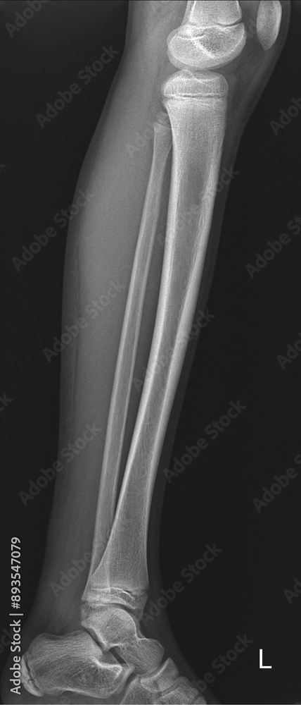 Lower limb tibia fibula lateral radiograph Stock Photo | Adobe Stock