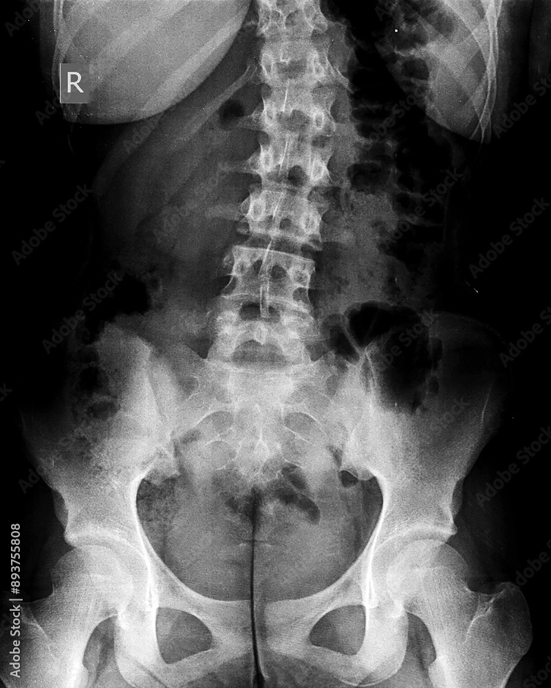 X-ray of idiopathic scoliosis of lumbar spine. Part of adolescent ...