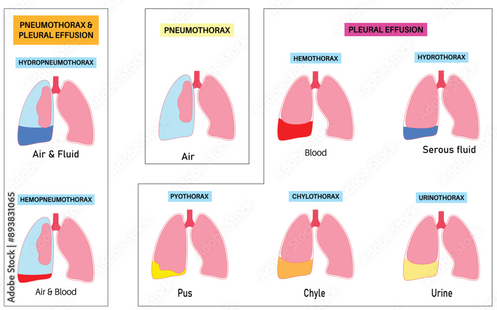 Medical Illustration of Pneumothorax and Pleural Effusion Types with Air, Blood, Serous Fluid ...
