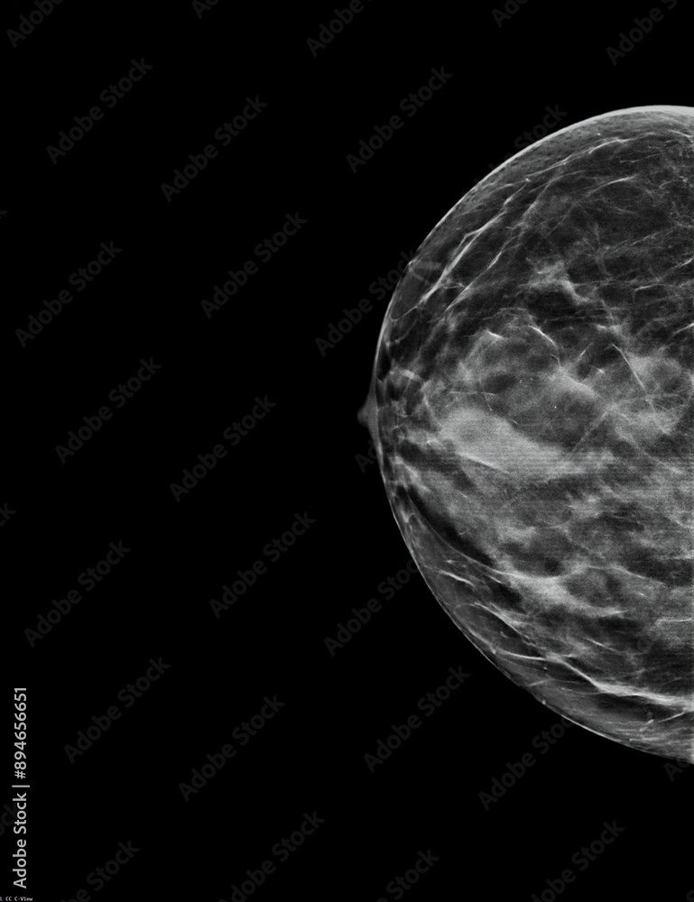 Stock-Foto „Mammogram. Left bilateral craniocaudal (CC) view (with ...