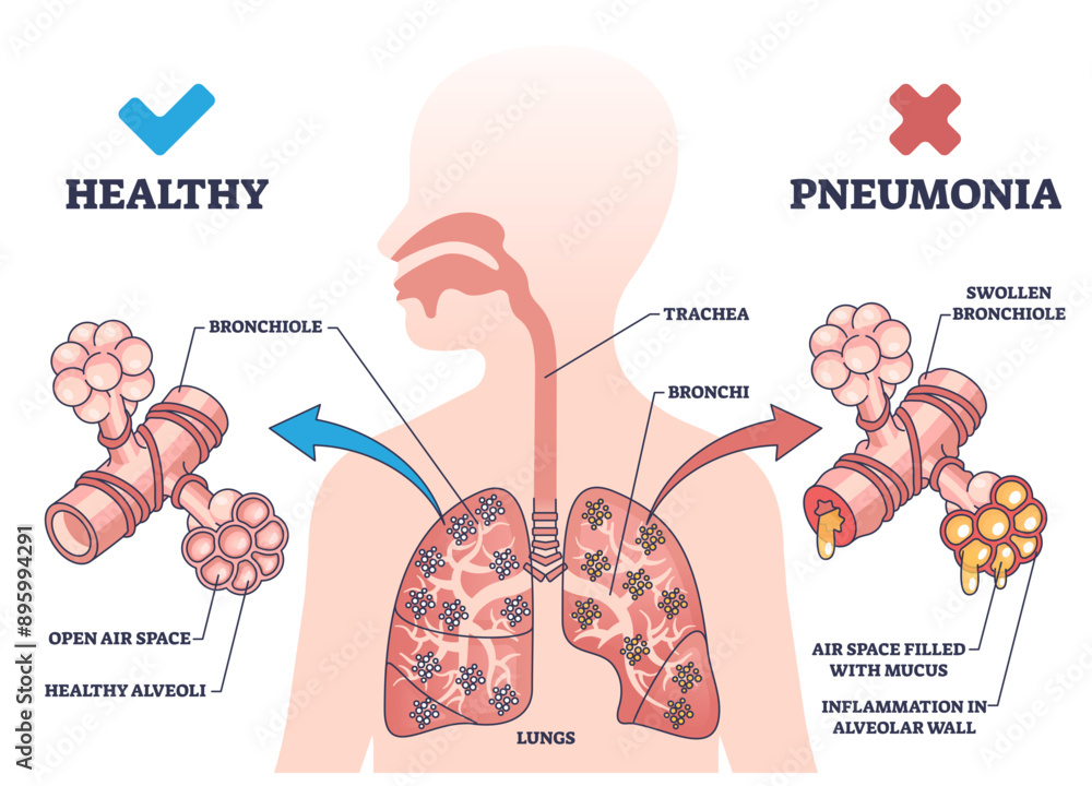 Pneumonia illness medical comparison with healthy lungs outline diagram ...