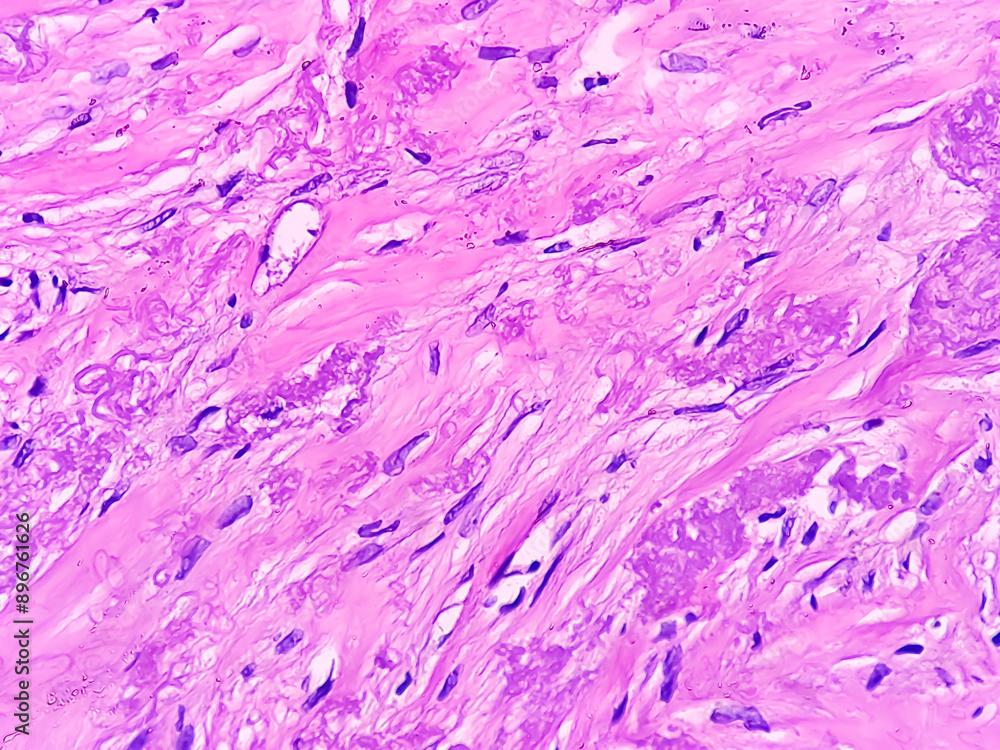 Fotografia do Stock Breast biopsy photomicrograph of infiltrating duct ...