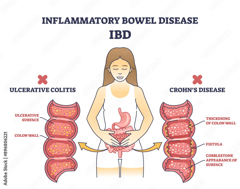 Inflammatory bowel disease or IBD with Crohns condition and ulcerative ...