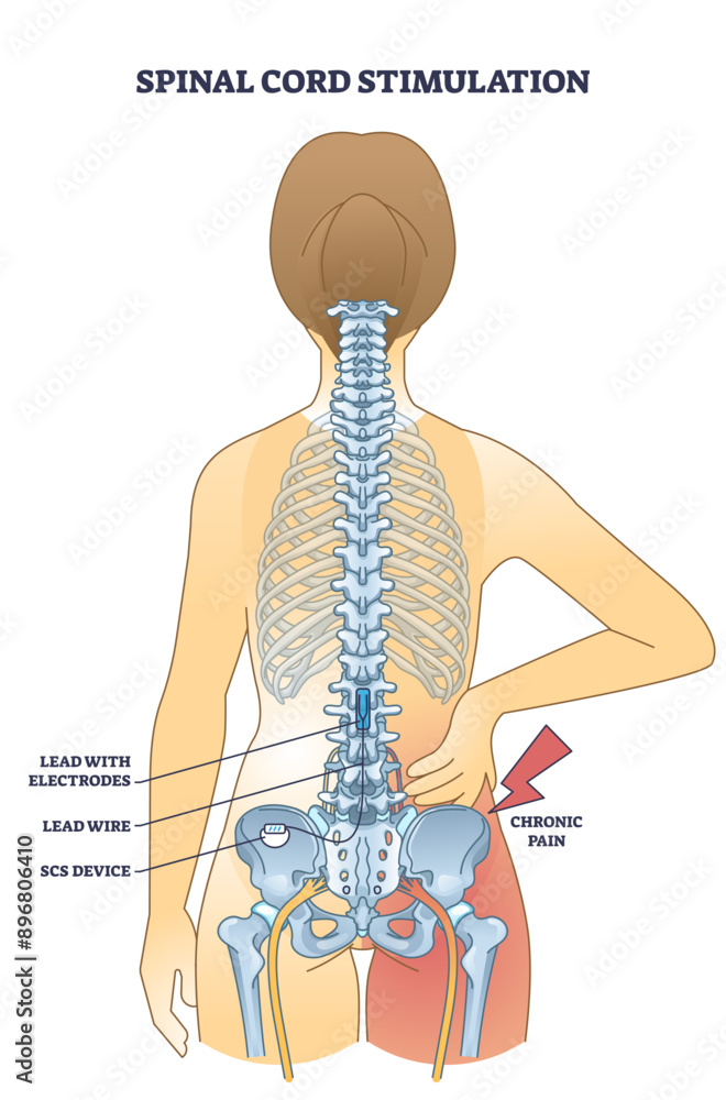 Spinal cord stimulation device for chronic back pain relief outline ...